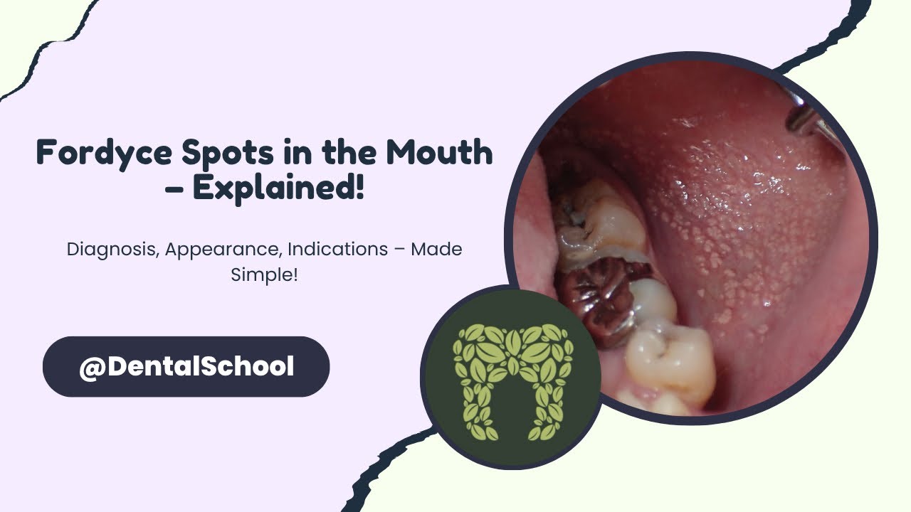 Fordyce Spots in the Oral Cavity | Everything You Need to Know - YouTube
