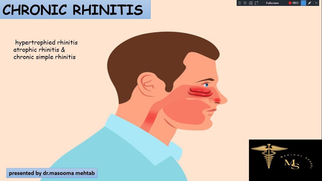 CHRONIC RHINITIS (Simple chronic rhinitis, hypertrophied rhinitis ...