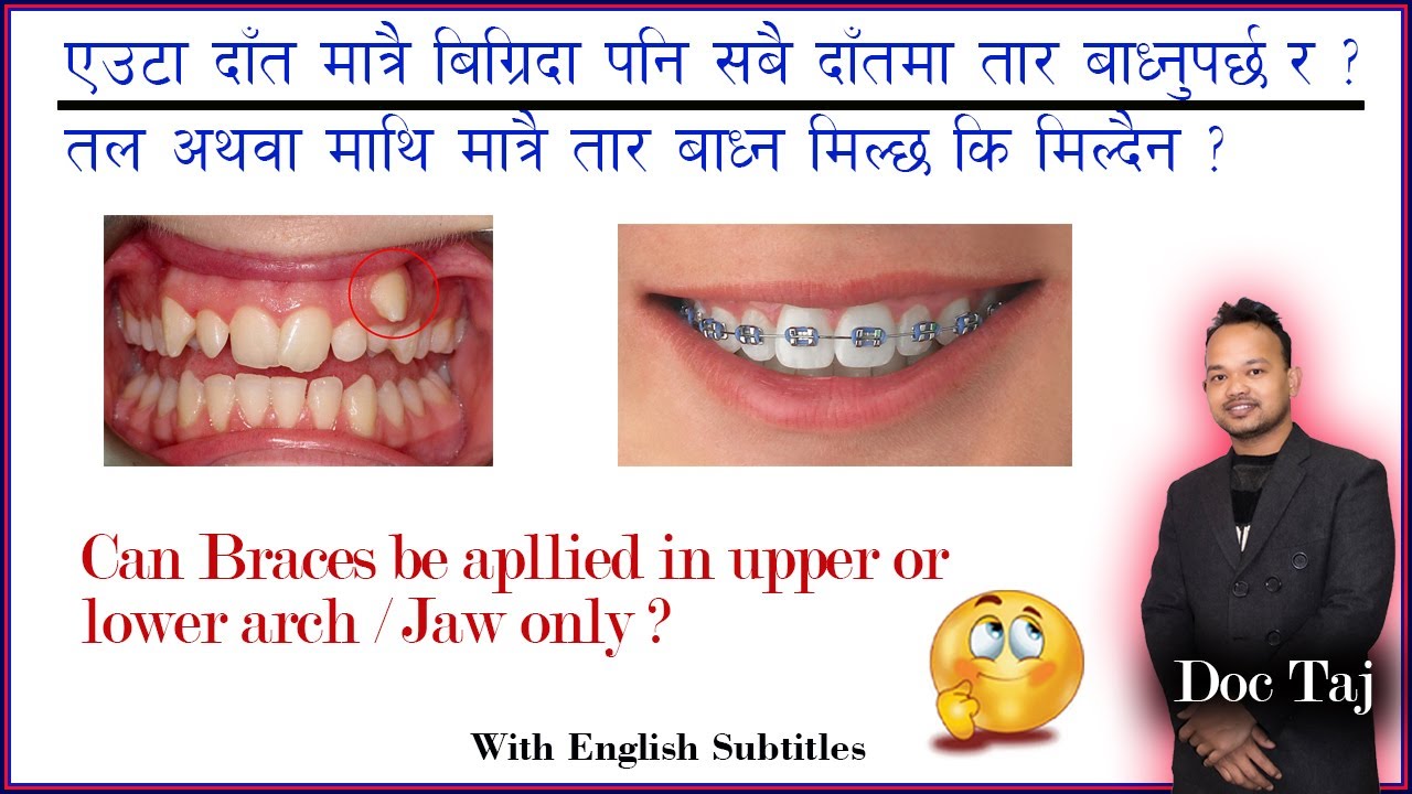 Braces in single arch/ why do we need to brace all the teeth for single ...