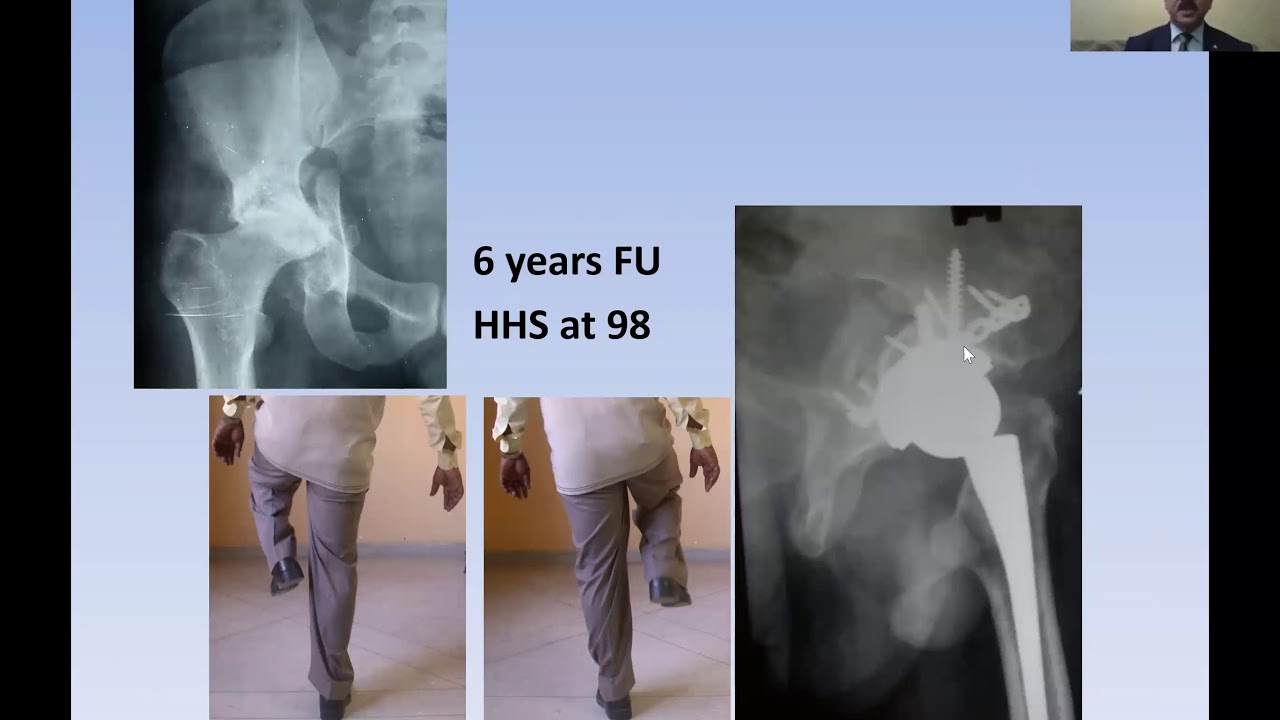 Dr Ramesh Sen THR in Acetabular Fractures - YouTube