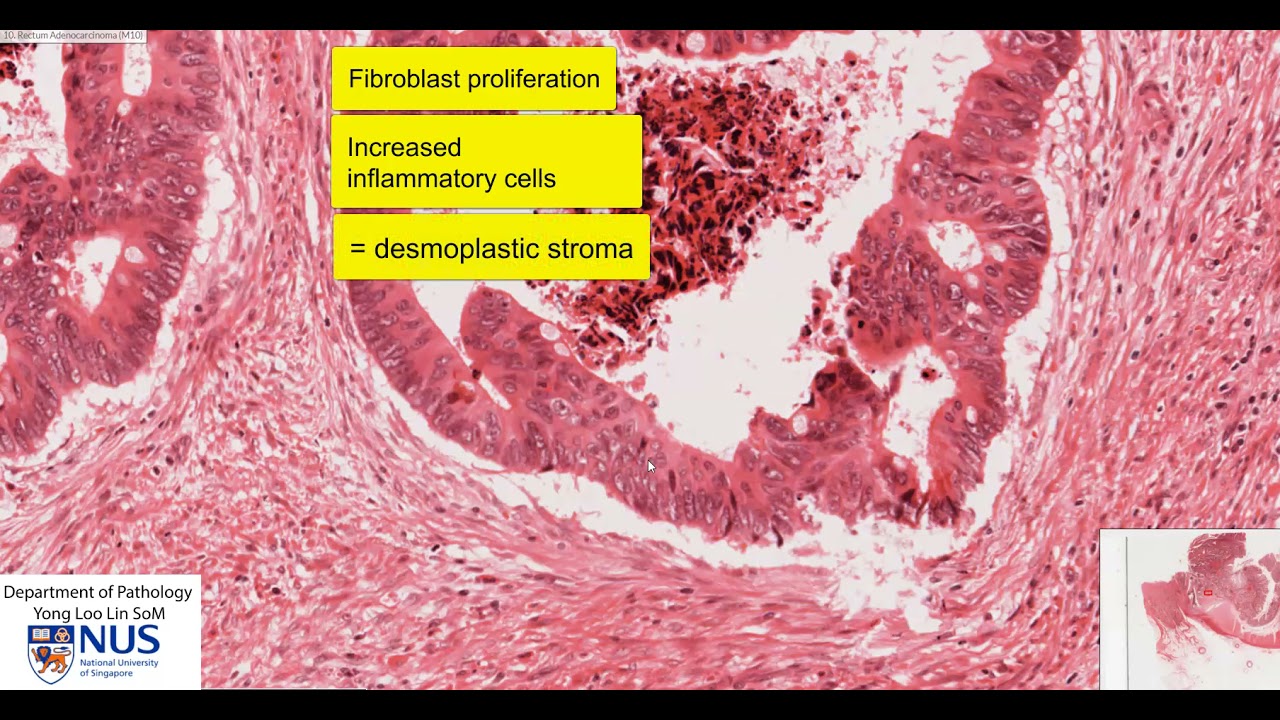 Colon carcinoma microscopy - Talking slide - YouTube