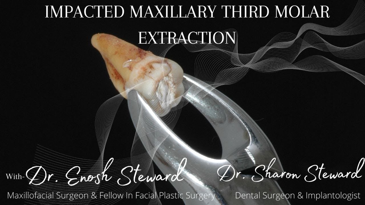 Maxillary Third Molar Extraction | Upper Third Molar Removal ...