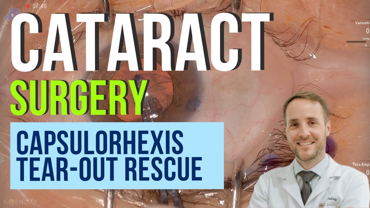 How to rescue a capsulorhexis tear-out? - Cataract Surgery - - YouTube