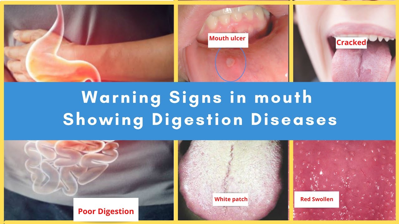 Digestion Problems and Oral Mouth Signs. Red Swollen White Cracked ...