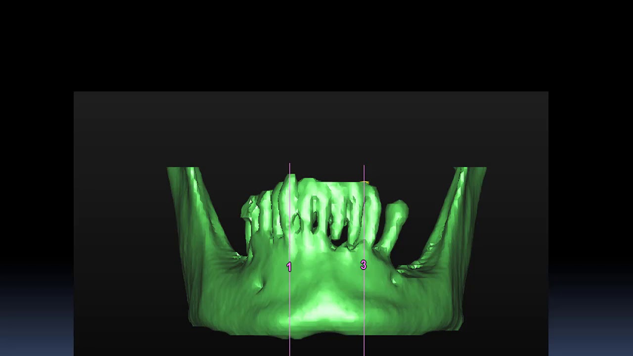 Full Lower Arch Rehabilitation With Dental Implant Overdenture Case ...