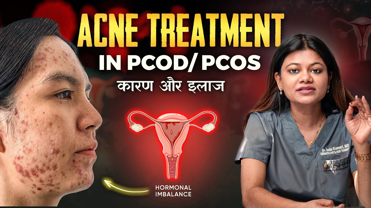 ACNE Treatment | Get Rid Of Pimples Due To PCOS & Hormonal Pimples ...