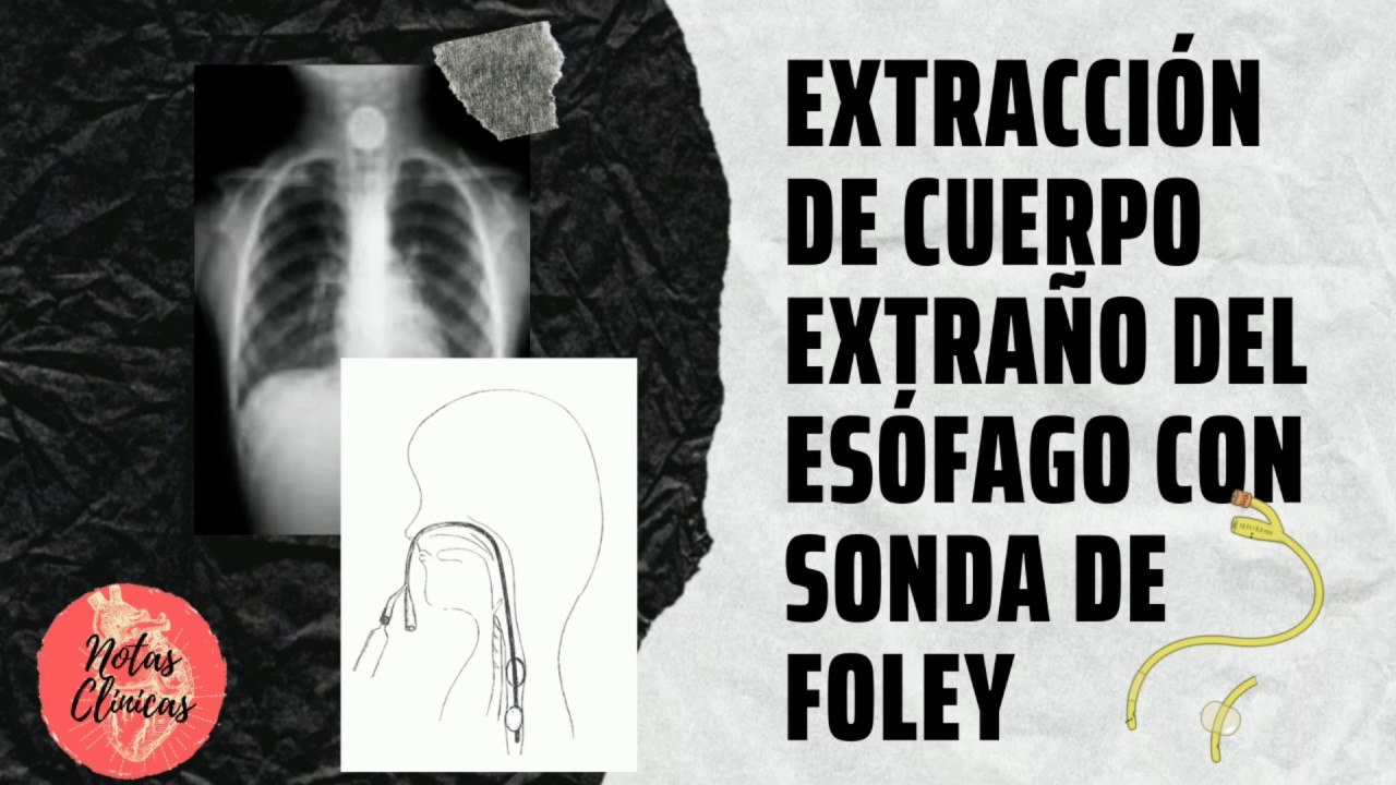 Extracción de cuerpo extraño del esófago con sonda de Foley ...