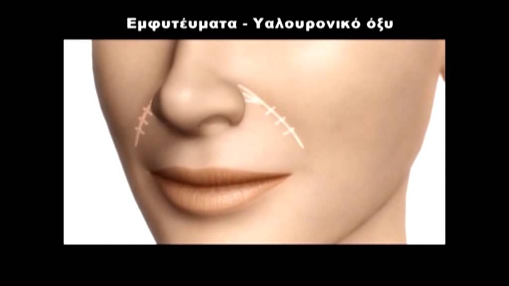 Υαλουρονικό οξύ - Αγγελίδης - YouTube