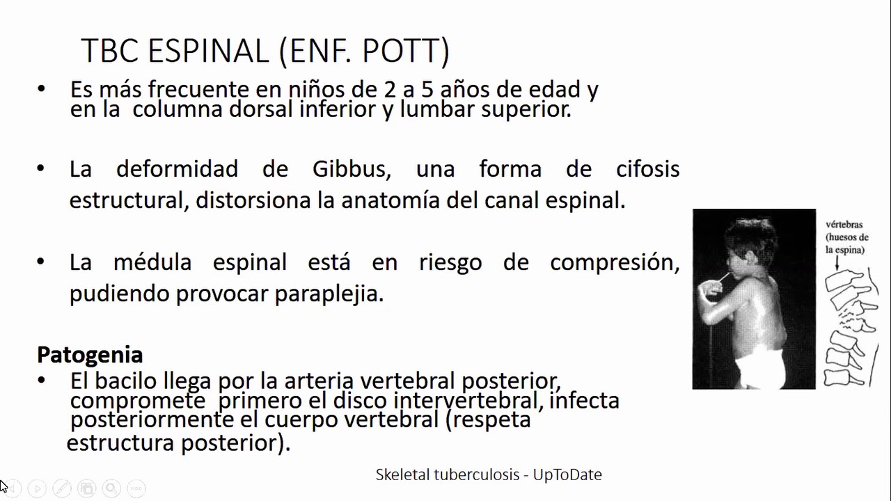 Tuberculosis Articular y Osteomuscular - YouTube