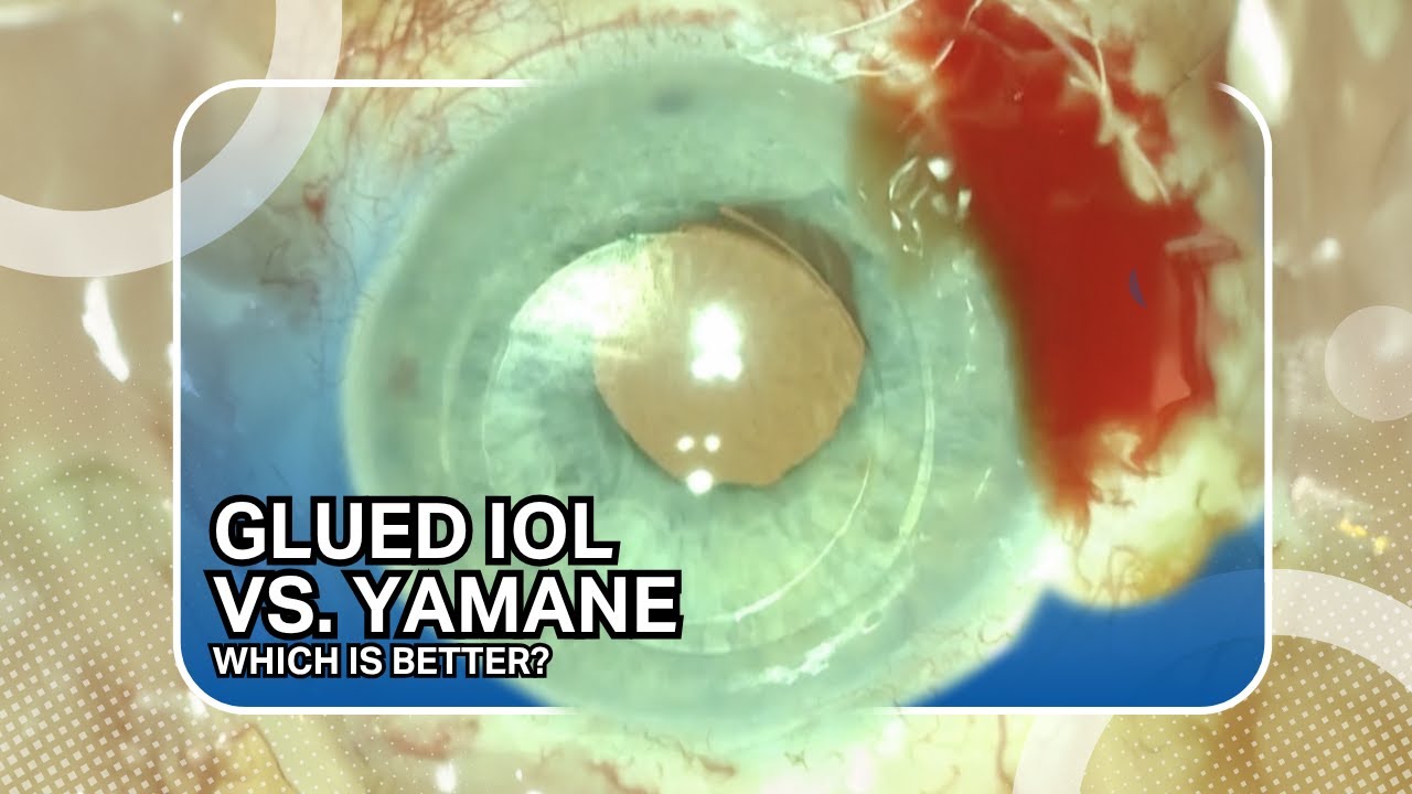 GLUED IOL vs. Yamane -- Which is Better? - YouTube