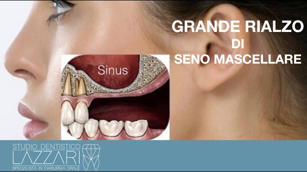 Grande rialzo di seno mascellare - YouTube