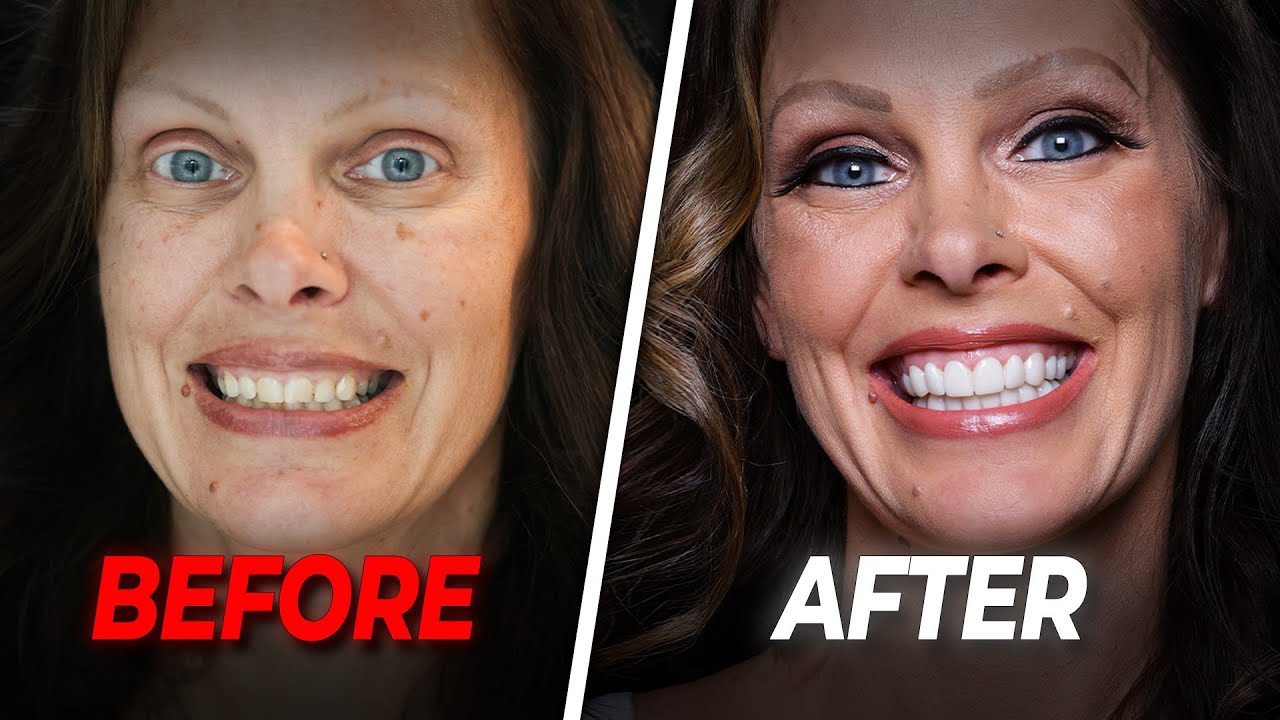 Pageant Winner's Secret Smile Makeover Reveal - No Cosmetic Dentist ...