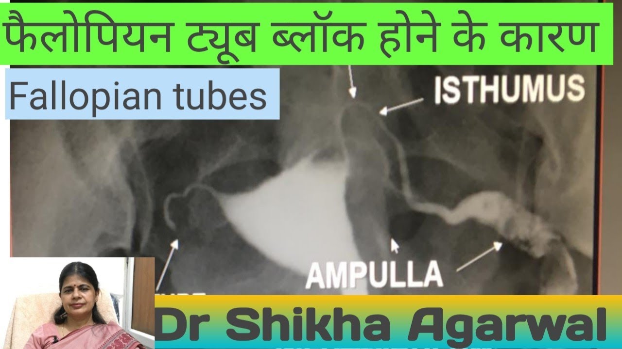Fallopian tubes /फैलोपियन ट्यूब ब्लॉक होने के कारण/Tube test /HSG ...