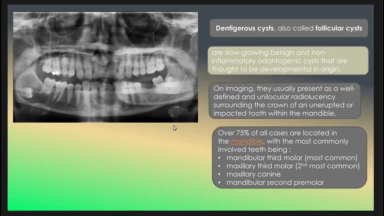 Dentigerous Cyst Canine