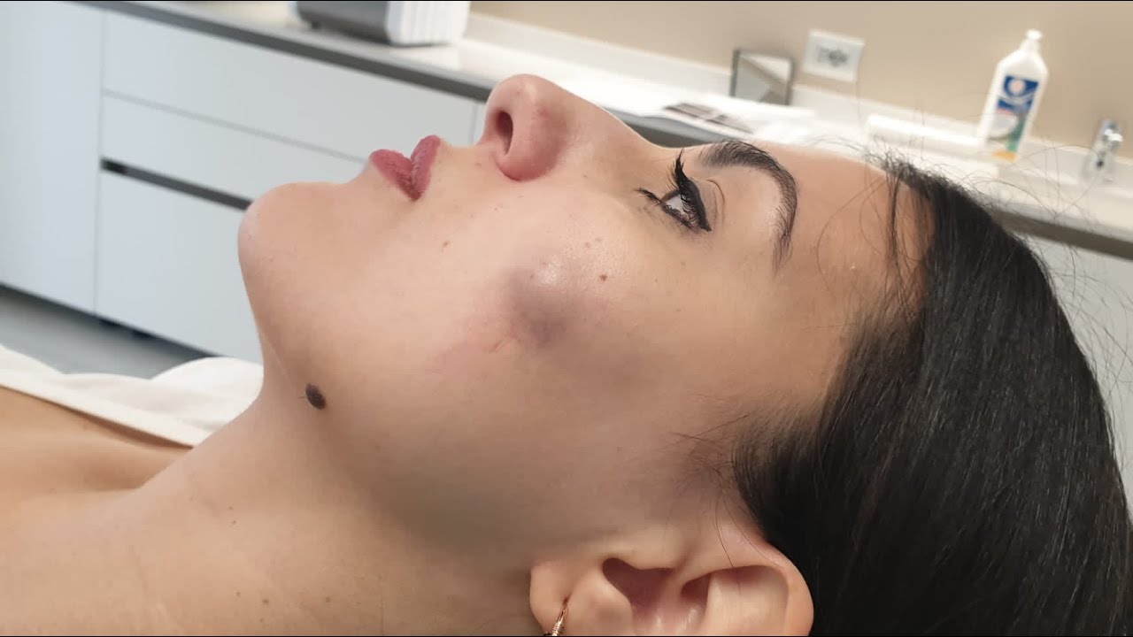 Rimozione cisti sebacea con Felc Plexr, risultato finale. - YouTube