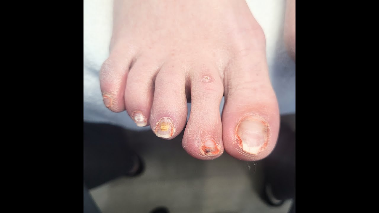 Diabetic neuropathy, toenail fungus, cracked nails, and callused heels ...