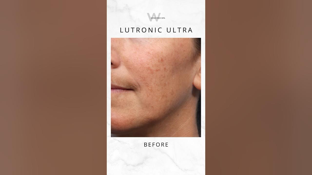 Before and after results: Lutronic Ultra Laser treatment to improve hyperpigmentation and skin ...