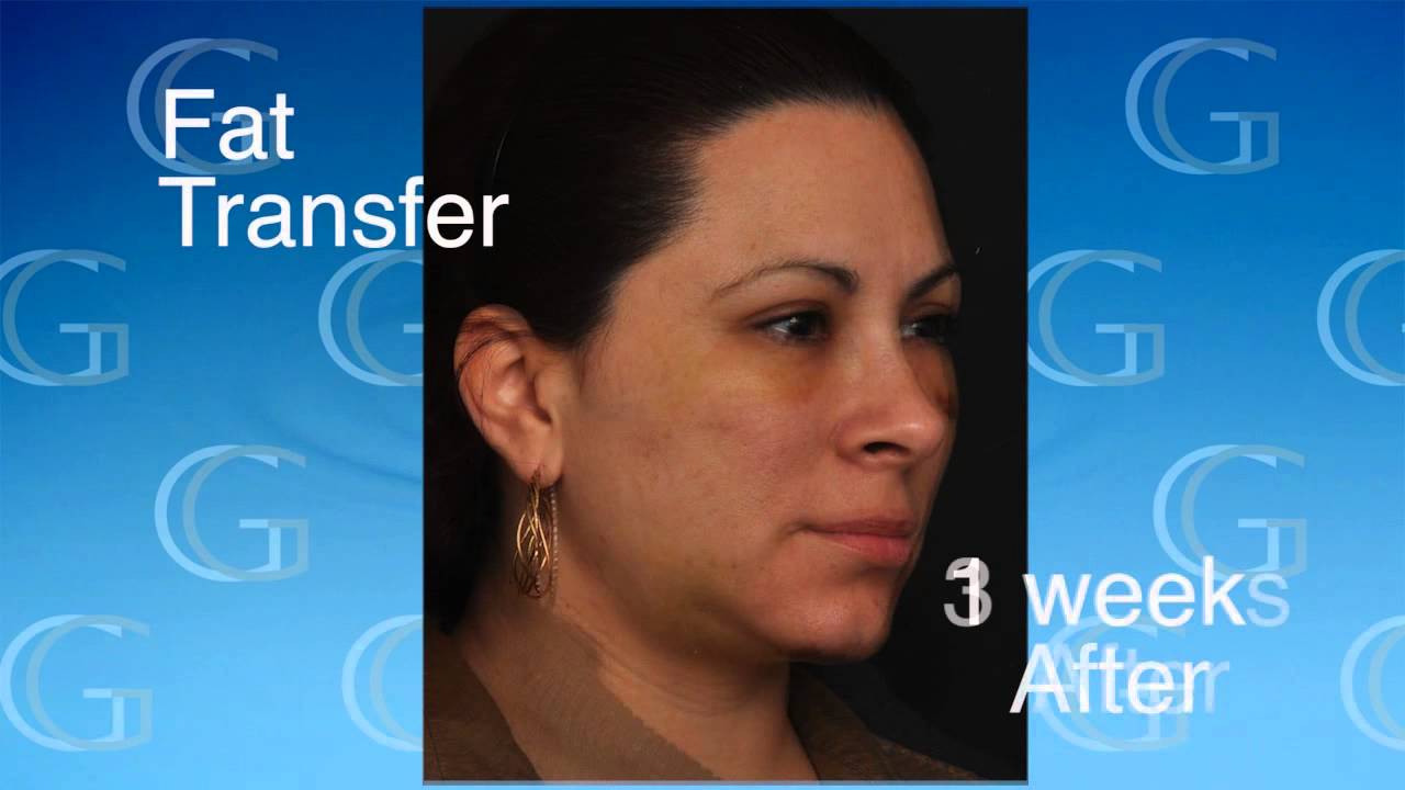 Fat Transfer Healing Process - New Jersey - Dr. Robert Glasgold - YouTube
