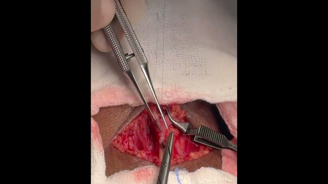 Arteriovenous fistula (AV Fistula) for dialysis/Brachiocephalic/Radiocephalic AV fistula/AVF ...