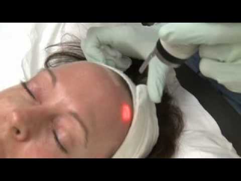 Active FX Fractional CO2 Laser Resurfacing - Part I | Austin ...