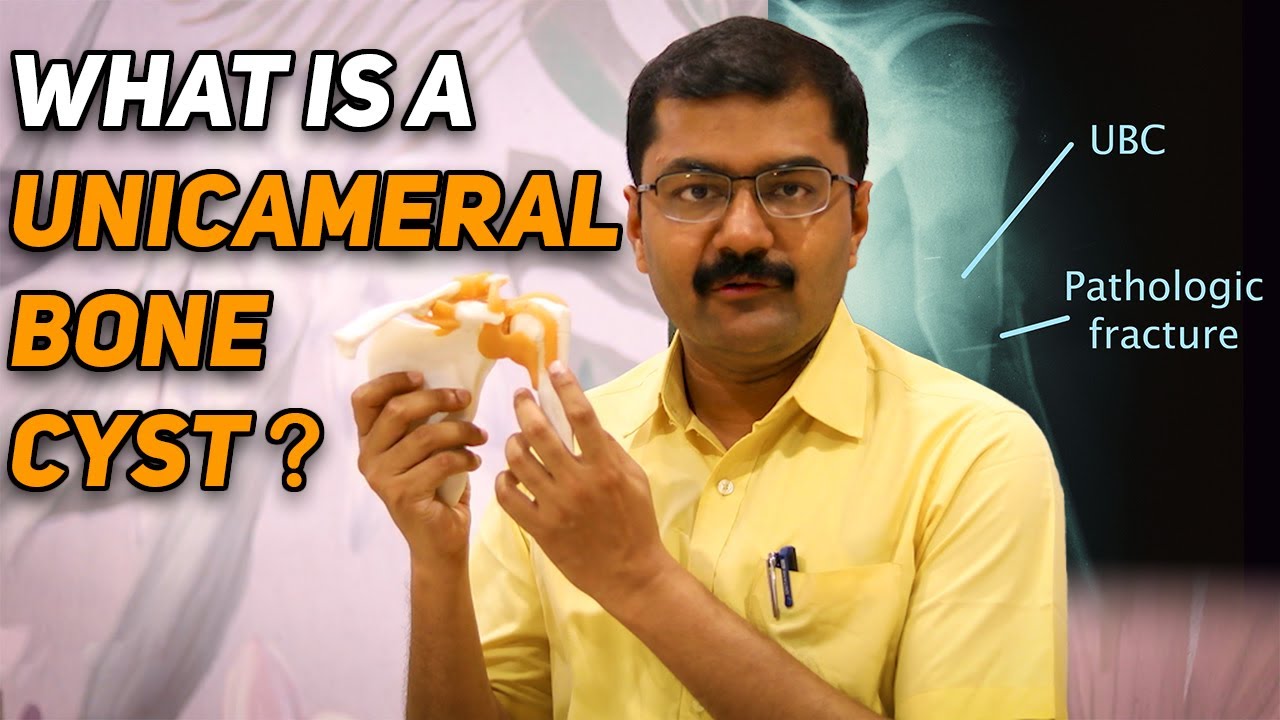 What is a Unicameral Bone Cyst? Dr. Soundar - YouTube
