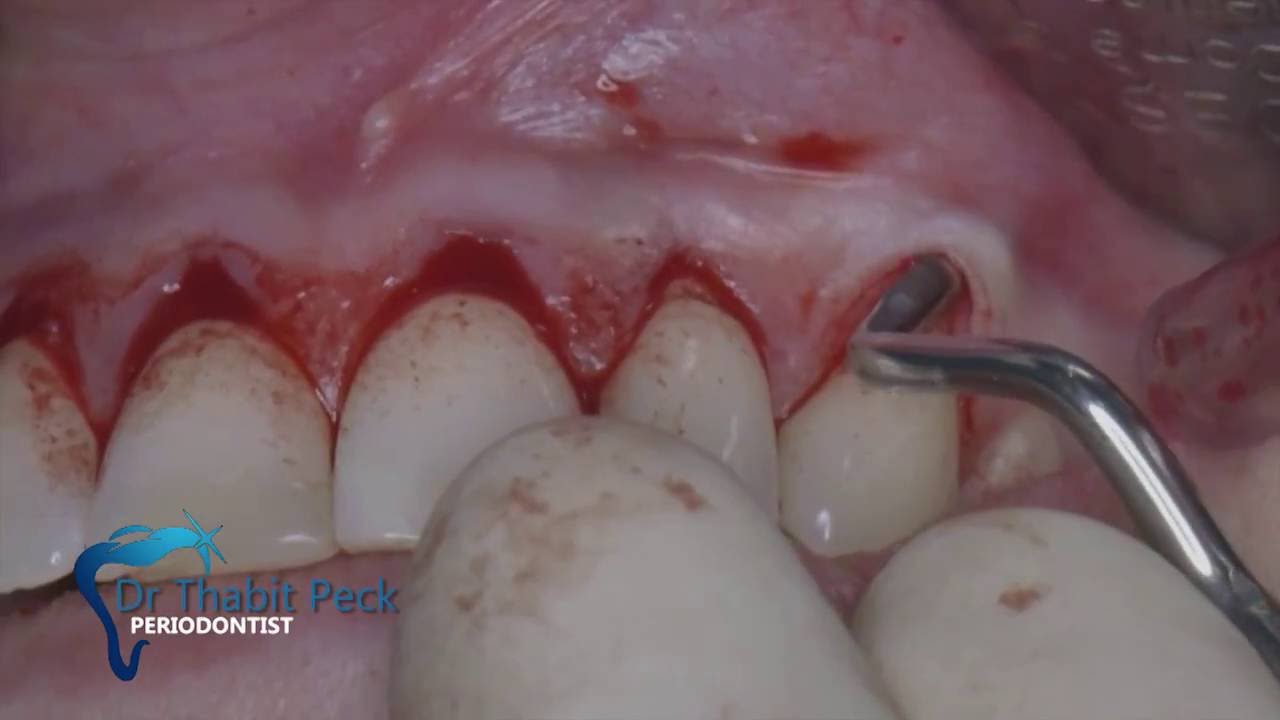 VISTA technique using Mucoderm collagen matrix - YouTube