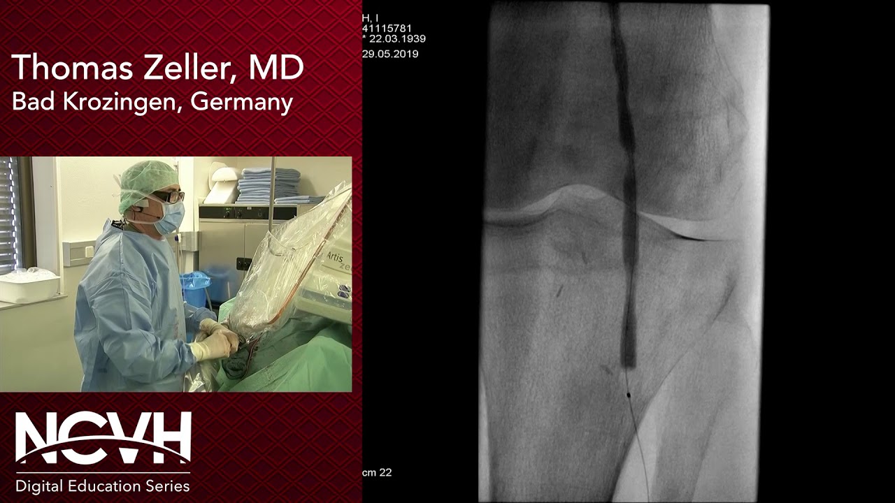 Prof. Thomas Zeller Live Case Recantilization of Left Popliteal Artery ...