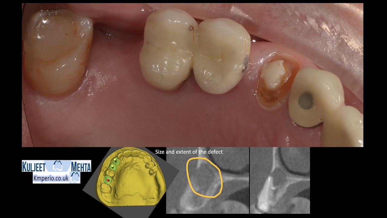 Dental Implant, Socket Shield and GBR - YouTube