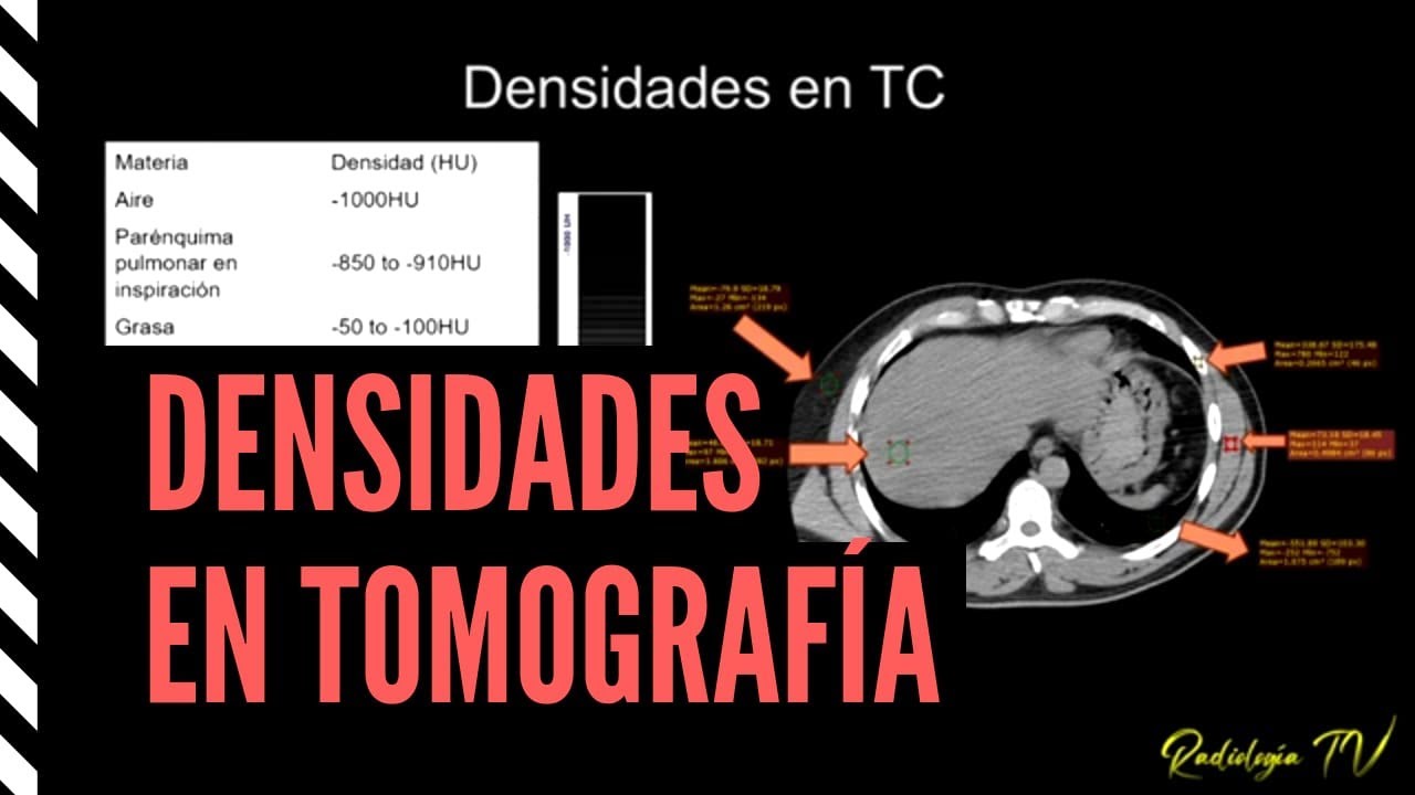 Densidades en tomografía - YouTube
