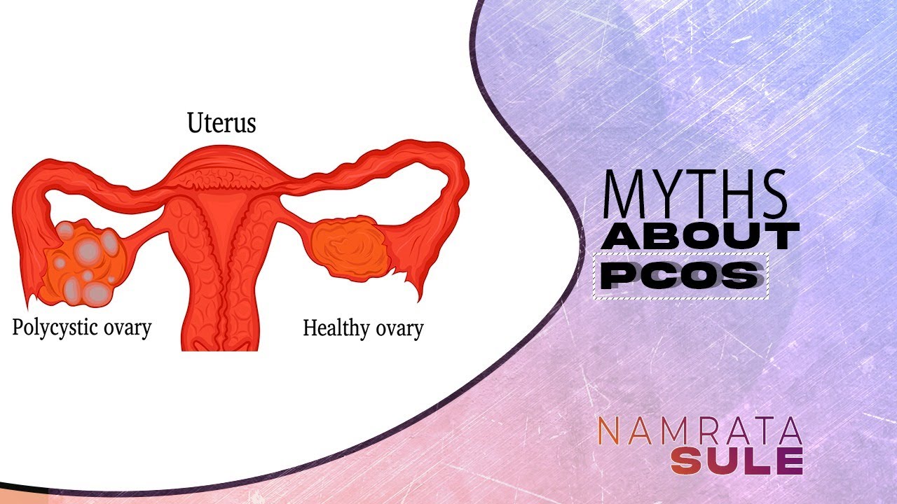 MYTHS ABOUT PCOS - YouTube