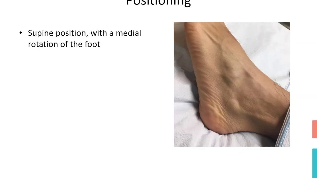 Sural nerve block ankle - YouTube