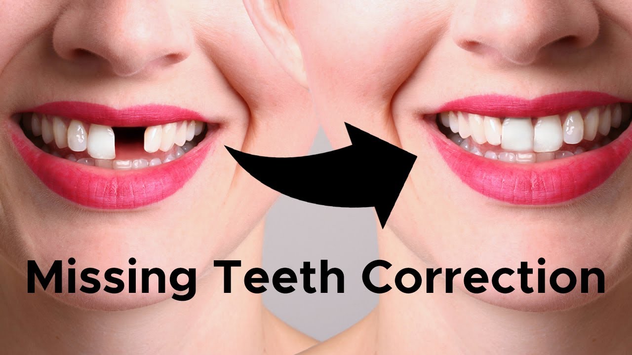 How to fix Missing Teeth in Photoshop - easy & step by step Tutorial - YouTube