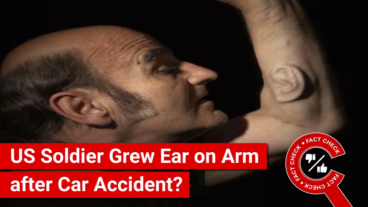 FACT CHECK: Viral Image Shows US Soldier who Grew an Ear on Arm after a ...