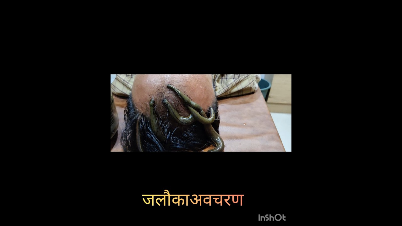 #jaloka #ayurved #skincare #traditional #medical #siya_ayurvedic # ...