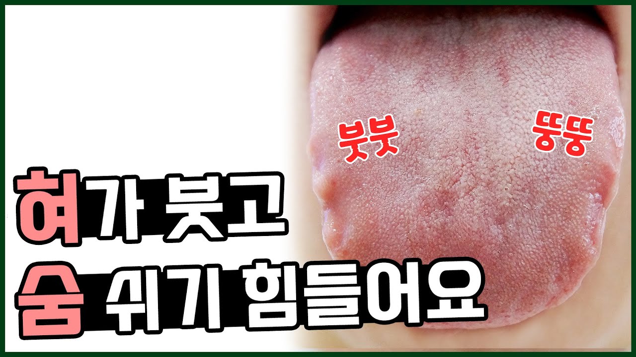 비허습담 혀가 붓고 혀에 이빨자국 치흔이 찍혀 있어요 Youtube