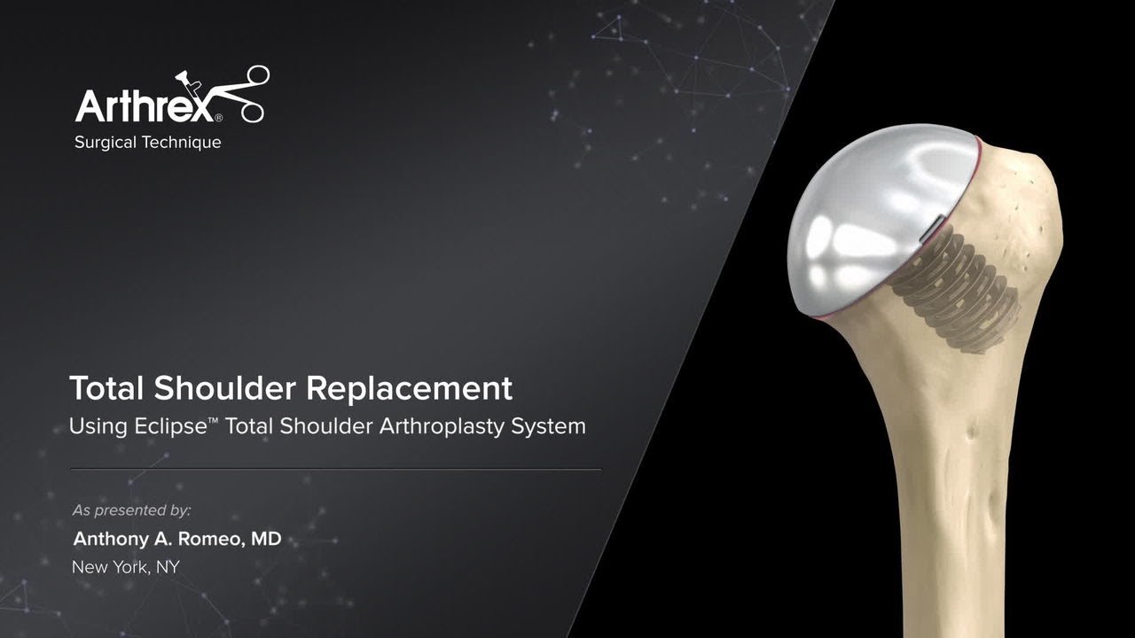 Total Shoulder Replacement Using Eclipse™ Total Shoulder Arthroplasty ...