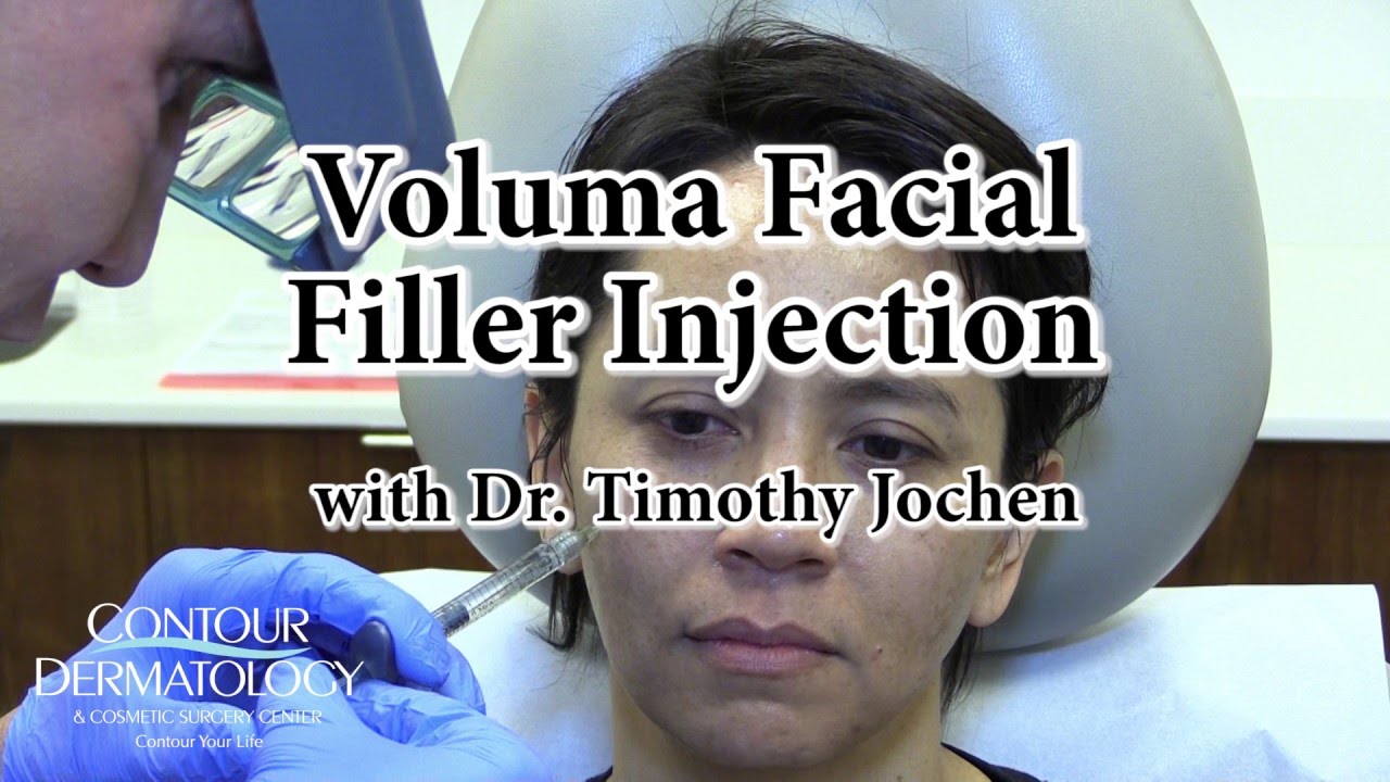 Voluma Facial Filler injection with Dr. Timothy Jochen - YouTube