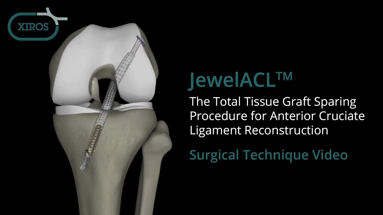 JewelACL Surgical Technique Video: Step by step guide - YouTube