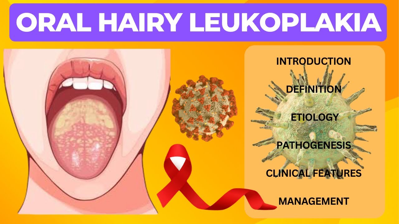 Oral Hairy Leukoplakia I Cause, Pathogenesis, Clinical Features ...