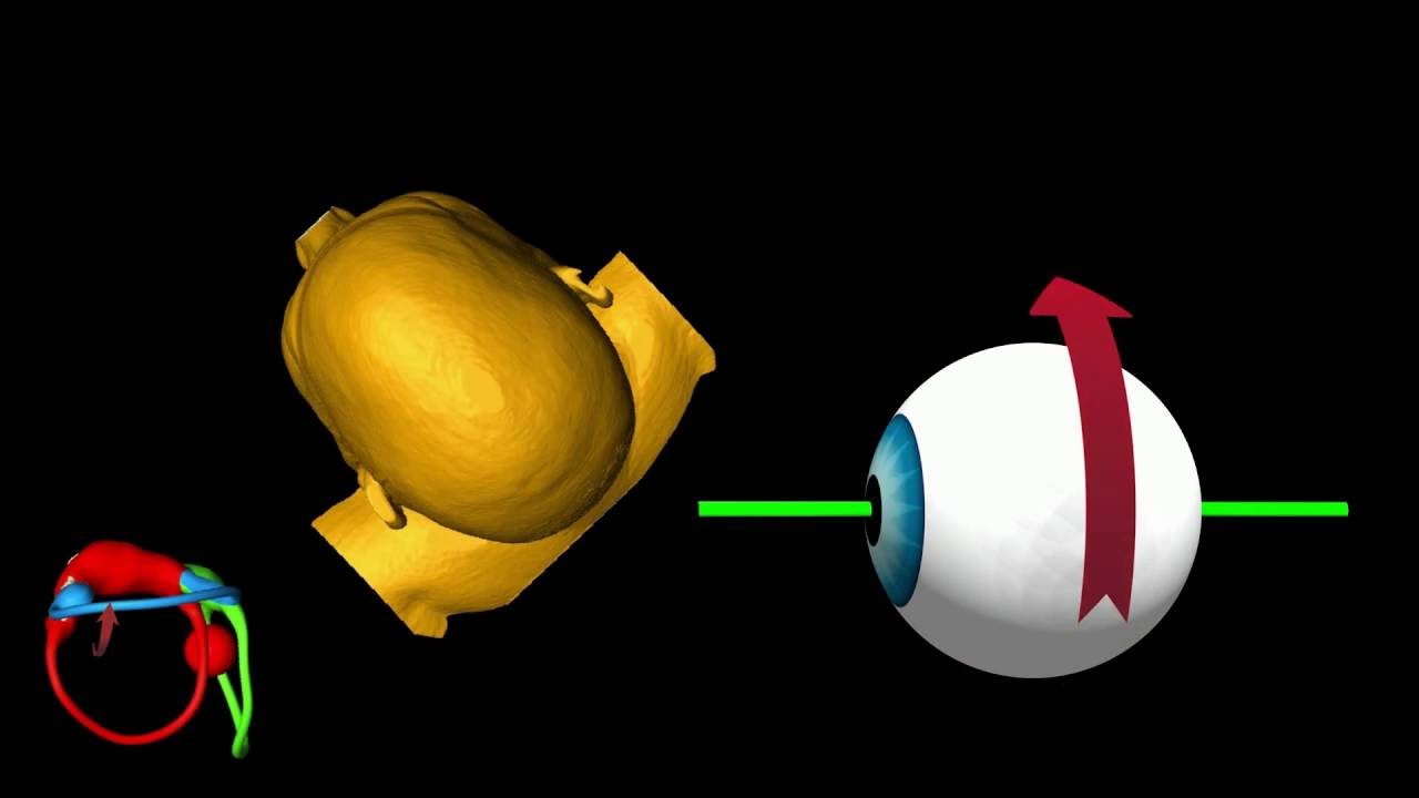 Eye Movement in Left Posterior Canal BPPV with Left Gaze - YouTube