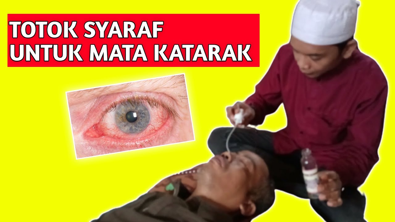 TOTOK SYARAF MATA KATARAK !!! - YouTube