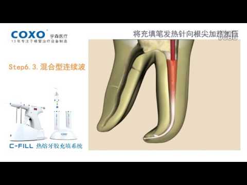 c-fill obturation system operation steps - YouTube