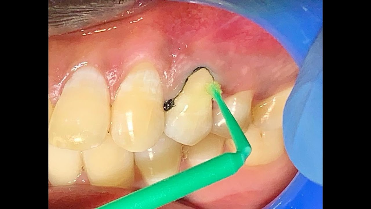 Class V Restoration using Retraction Cord - YouTube