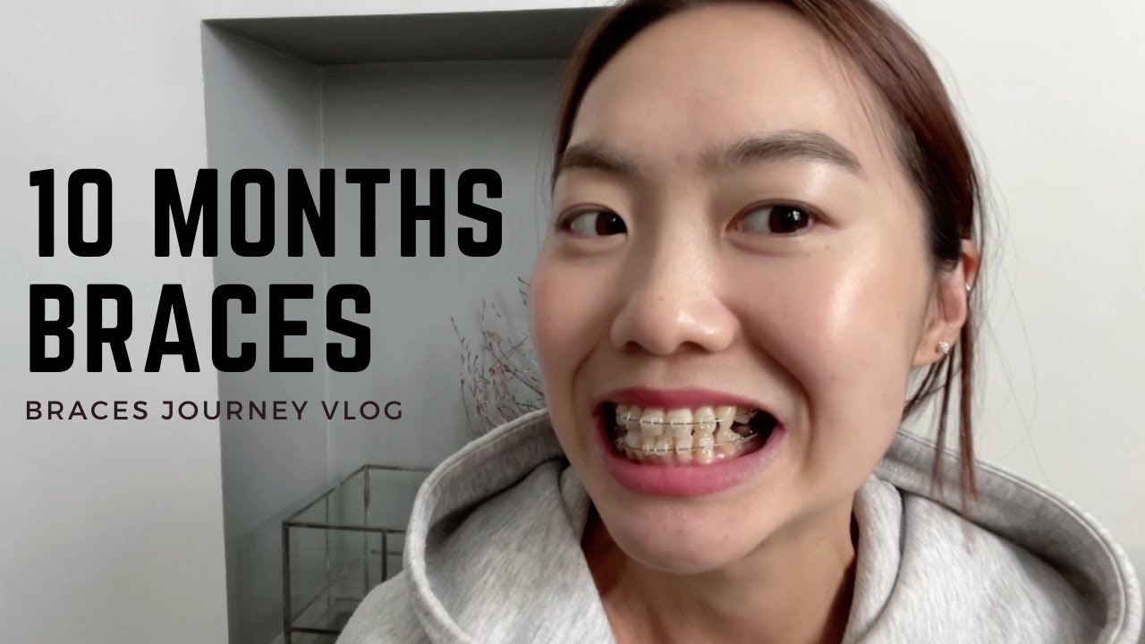 [Braces Vlog #5] 10 MONTHS ADULT BRACES UPDATE 🤍 🦷 - YouTube