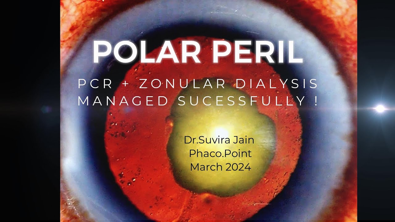 POLAR PERIL - Polar cataract with combined PCR and Zonular Dialysis. Managed successfully - YouTube