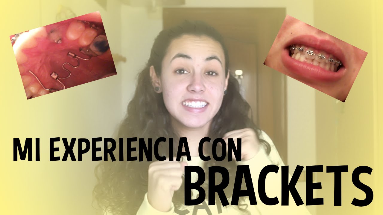 Mi experiencia con brackets - YouTube