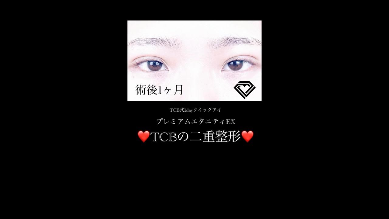 【二重整形】TCB式1dayクイックアイ（二重埋没法）プレミアムエタニティEX ️術後1ヶ月 #shorts #tcb #二重整形 #二重埋没 - YouTube