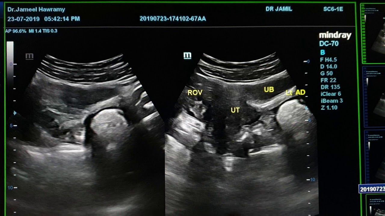 Dermoid Lesion Sonography - YouTube