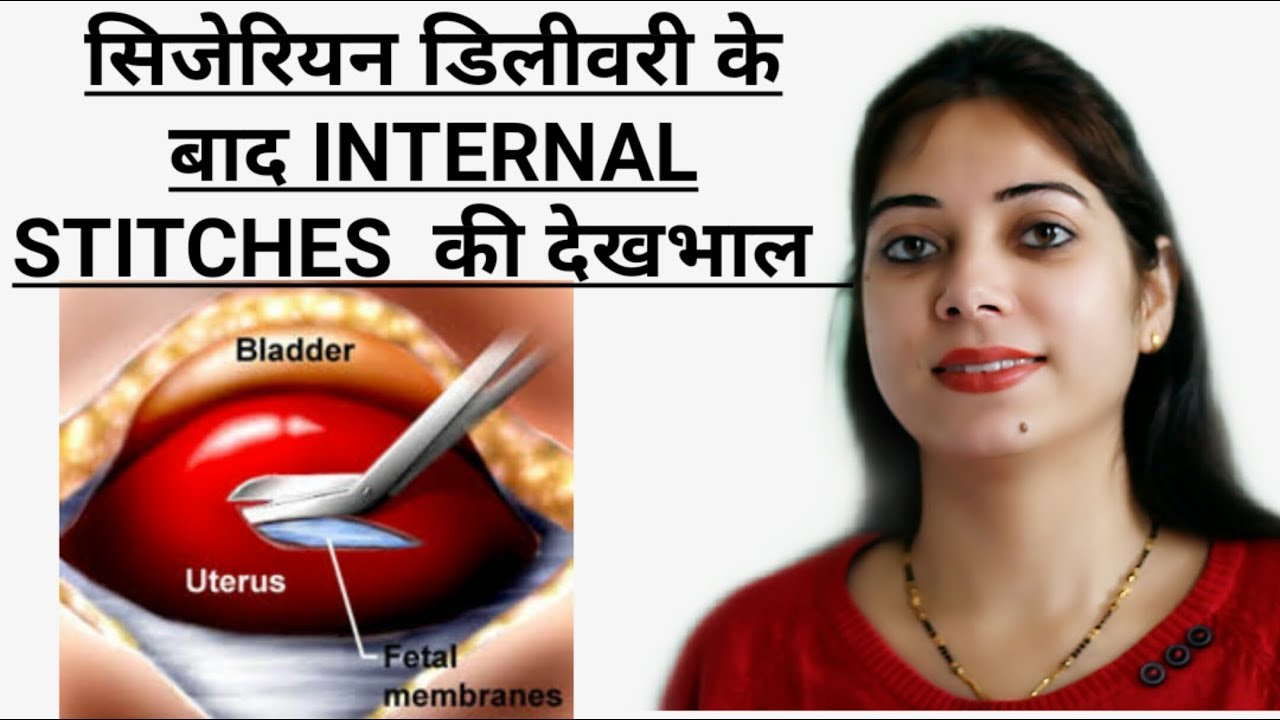 सिजेरियन के बाद INTERNAL STITCHES की देखभाल|How to takecare of stiches ...