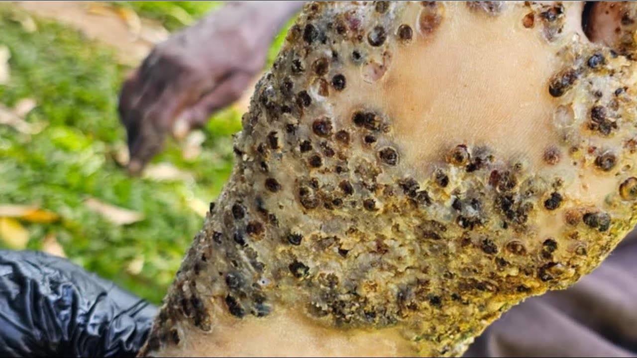 Meshack Salano's jigger dig rotten smothered jiggers extracted August ...